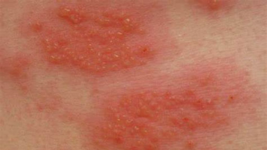 Dermatite da sudore: rimedi efficaci e possibili soluzioni - Ermes Ambiente